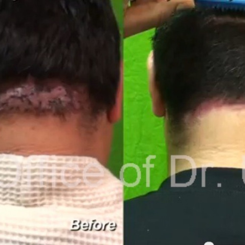 Skin Condition of Acne Keloidalis Nuchae| Dermatology