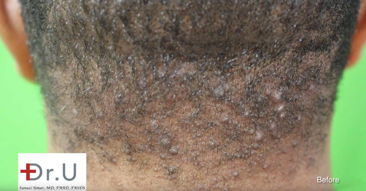 Medical Bumps on Back of Head Treatment – Acne Keloidalis Nuchae